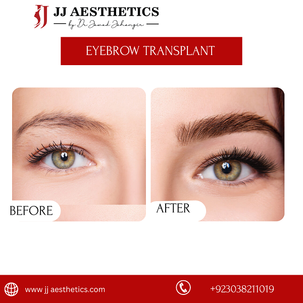 Eyebrow Transplant In Islamabad Rawalpindi & Pakistan | JJ Clinic