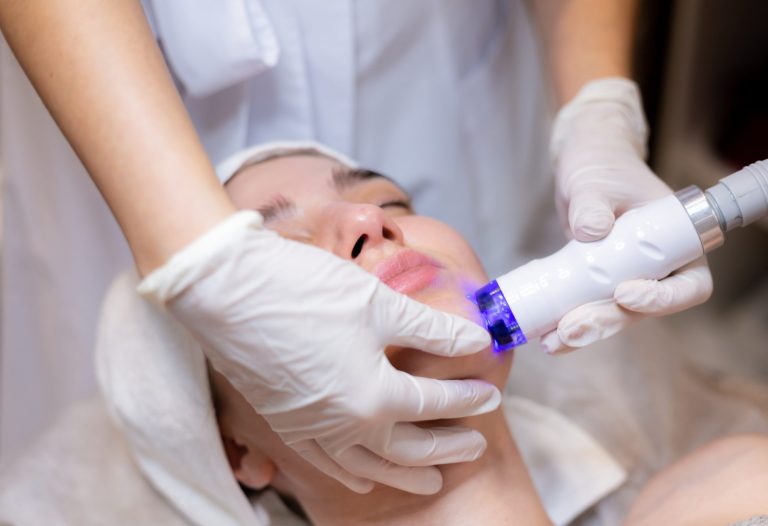 RF Micro-Needling Treatment in Islamabad, Rawalpindi & Pakistan