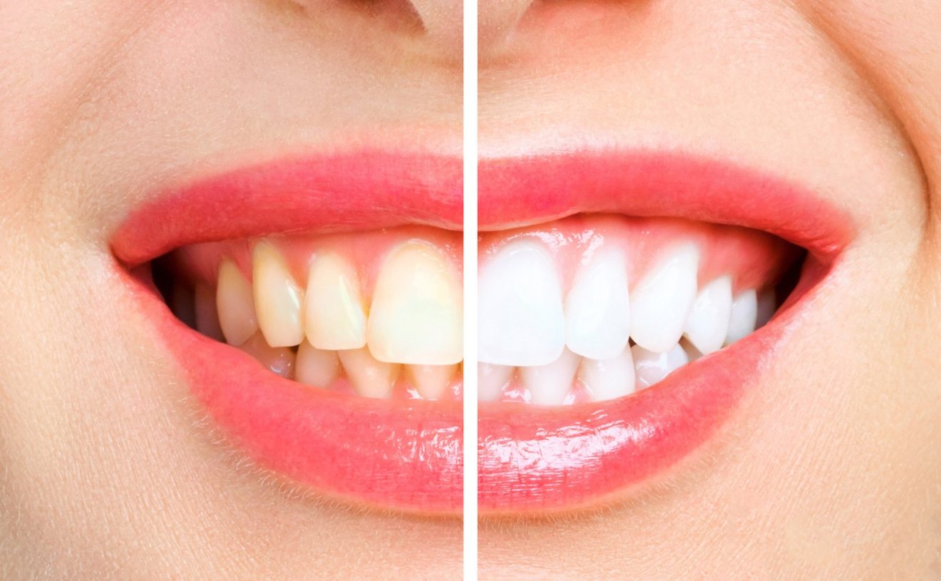 Does enamel grow back after teeth whitening?