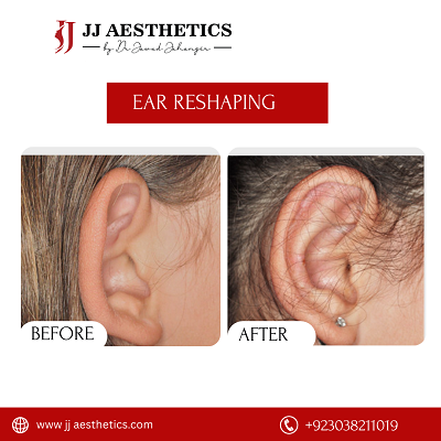 Ear surgery in Islamabad Rawalpindi & Pakistan | Otoplasty