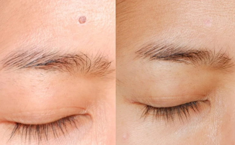 What Is The Best Age For Mole Removal in Islamabad?