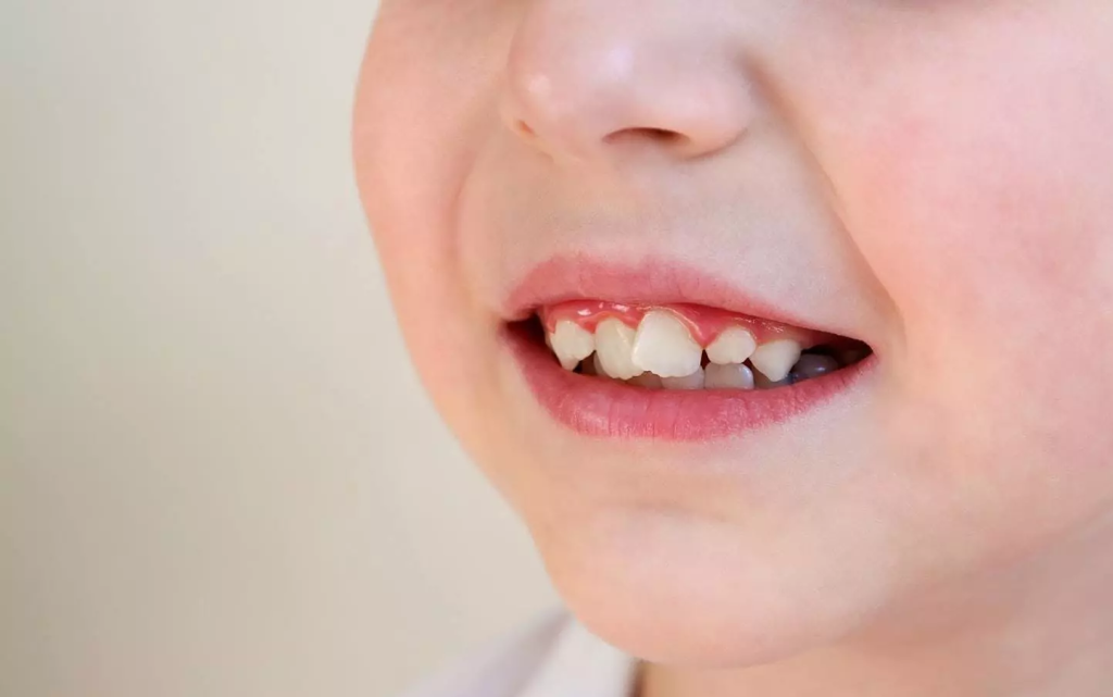 Overlapping Teeth Treatment in Islamabad