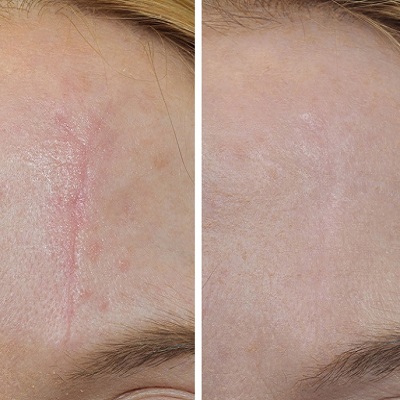 Post Surgical Scar Revision in Islamabad