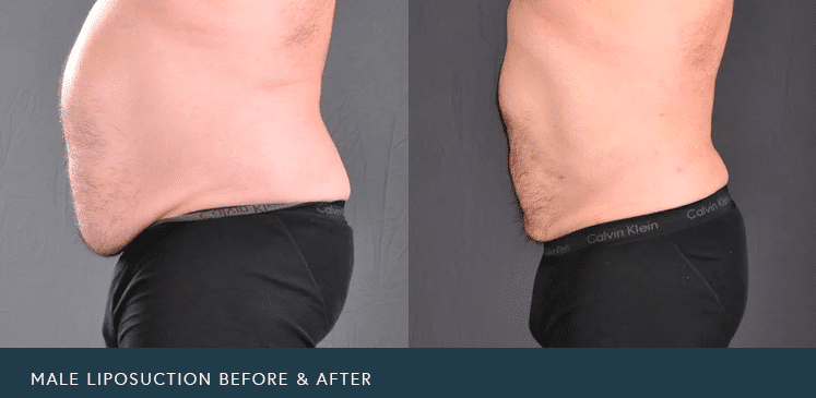 Liposuction for Stubborn Fat | Before & After Results